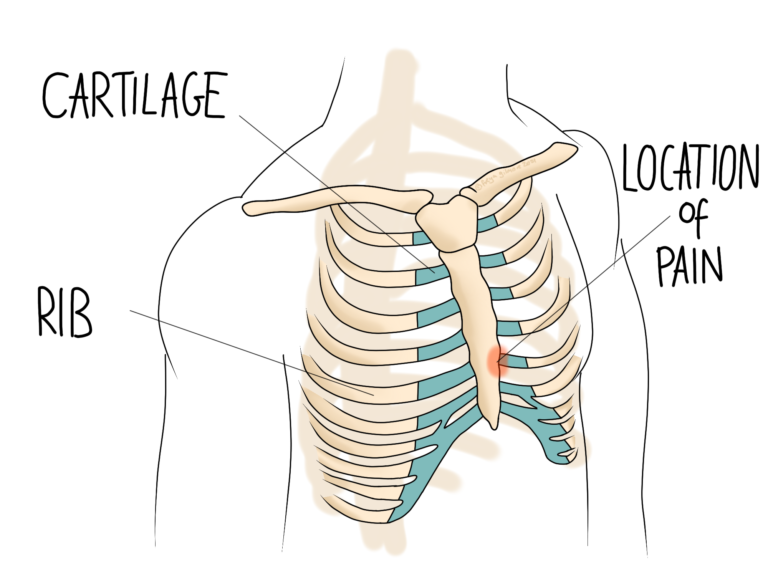 Costochondritis: Rib Pain - Gemini Osteopathy